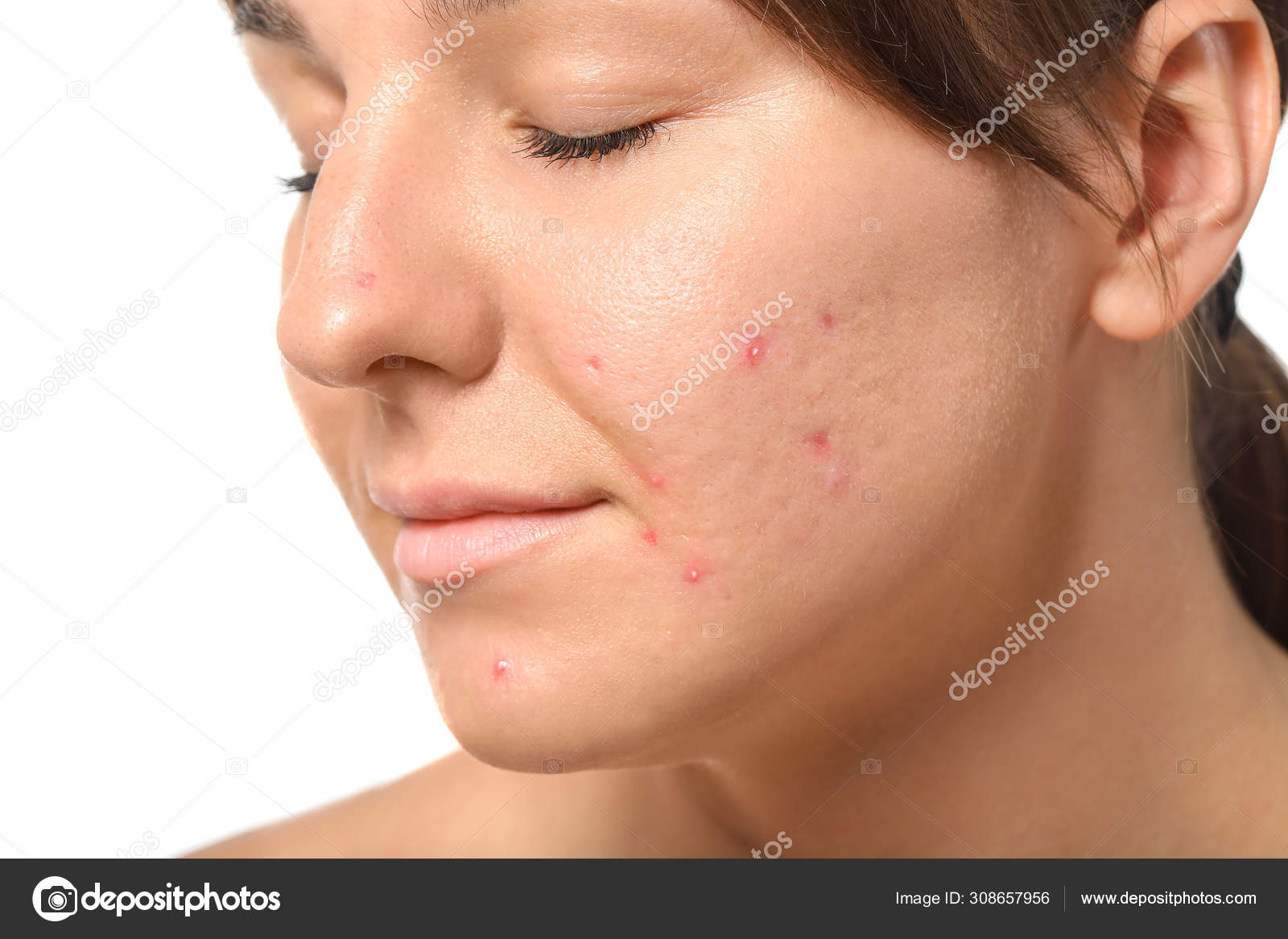 Mujer joven con problemas de acné sobre fondo blanco, primer plano ...
