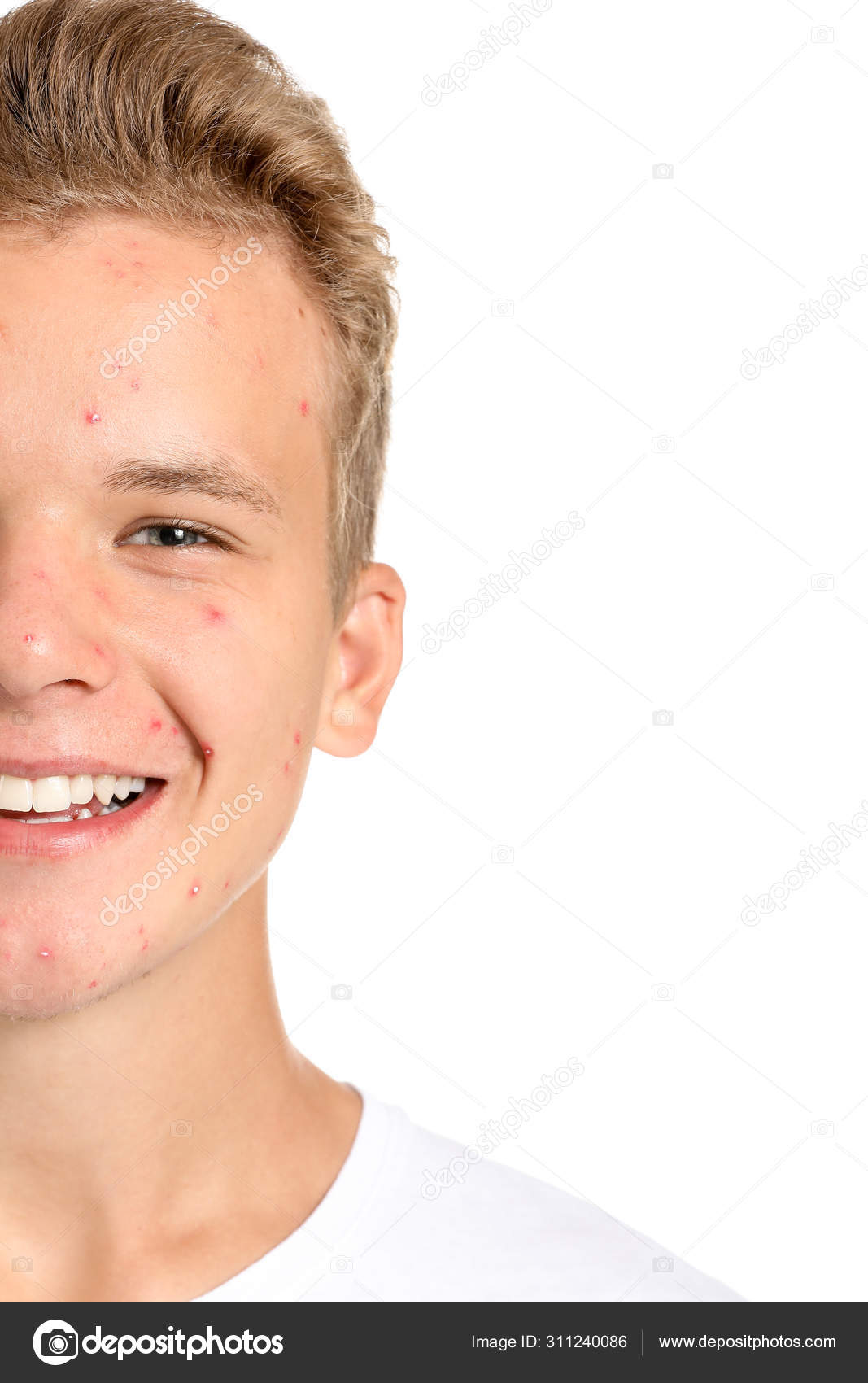 Teenage boy with acne problem on white background Stock Photo by ...