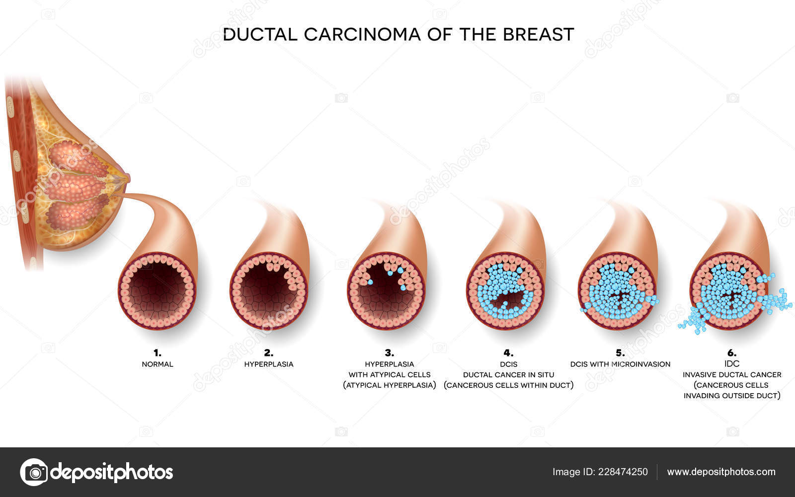 Ductal Carcinoma Breast Cross Section Anatomy Detailed Anatomy ...