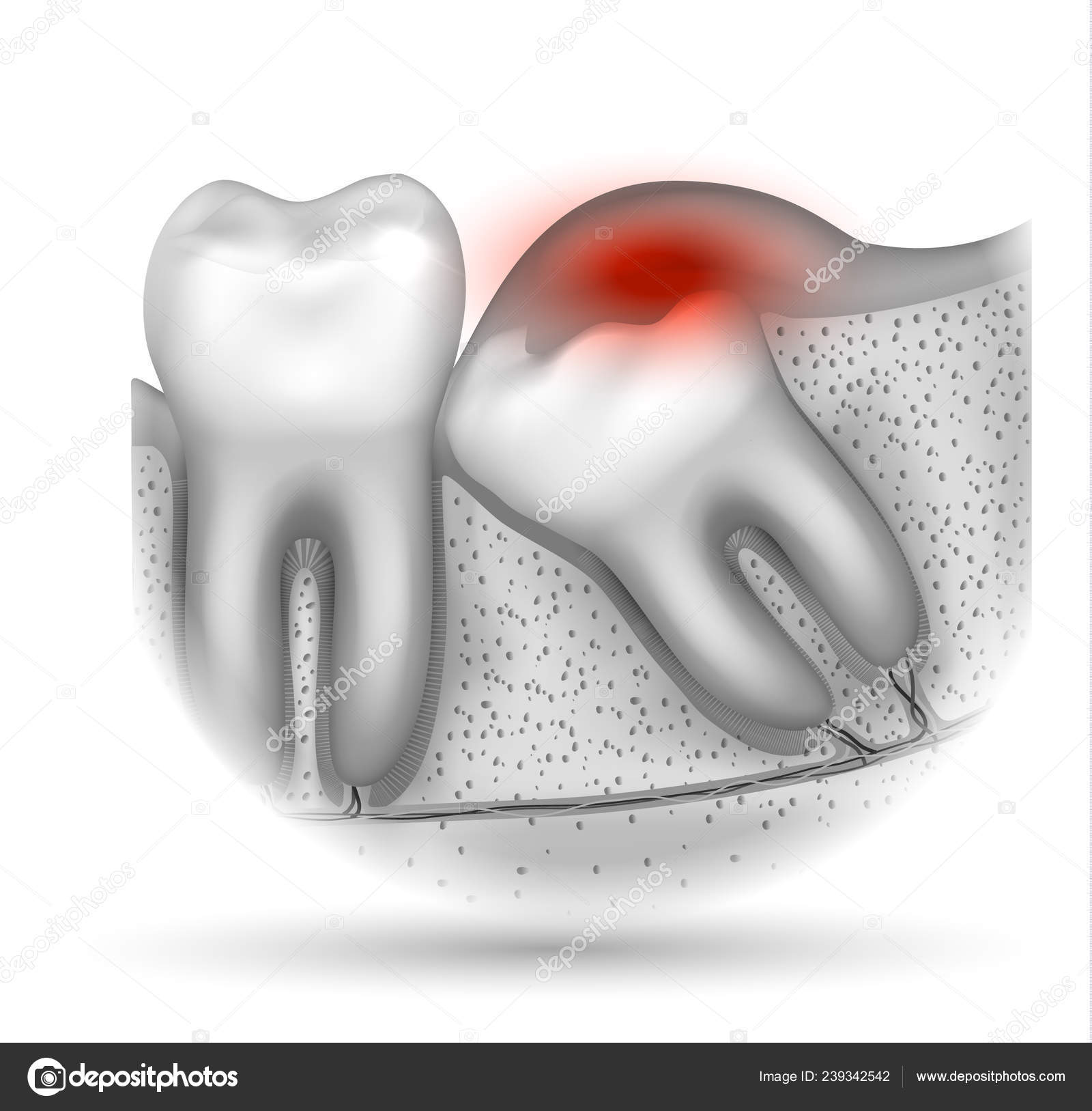 Wisdom Tooth Eruption Problems Inflamed Gums Illustrated Anatomy Stock ...