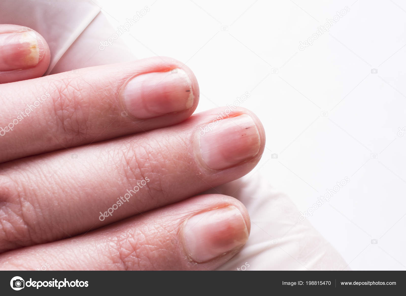 Onycholysis Isolated White Background Mechanical Damage Nail Plate ...