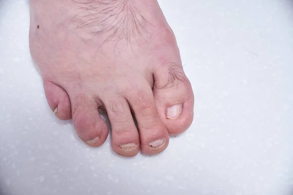 Male nails destroyed by onycholysis. Damage to the male foot nails. At ...