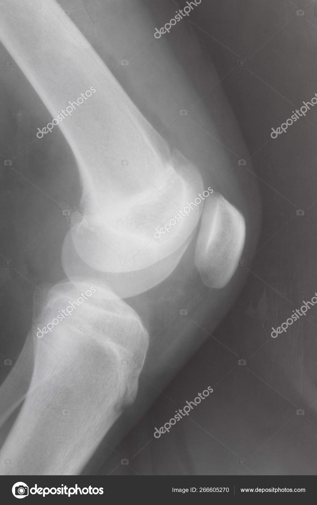 Rótula humana con rótula en imagen de rayos X: fotografía de stock ...