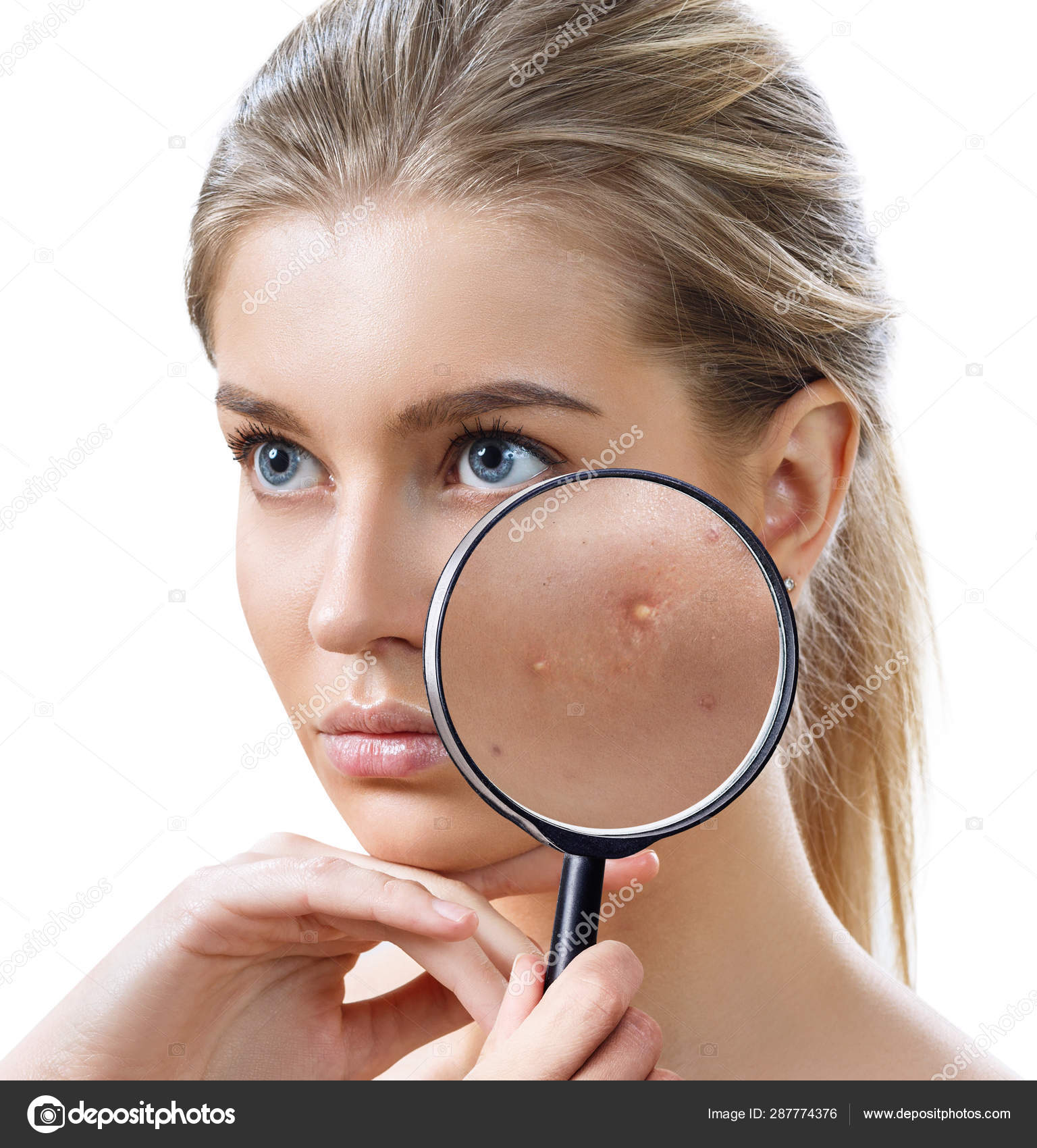 Young woman with magnifying glass shows skin with acne. Stock Photo by ...