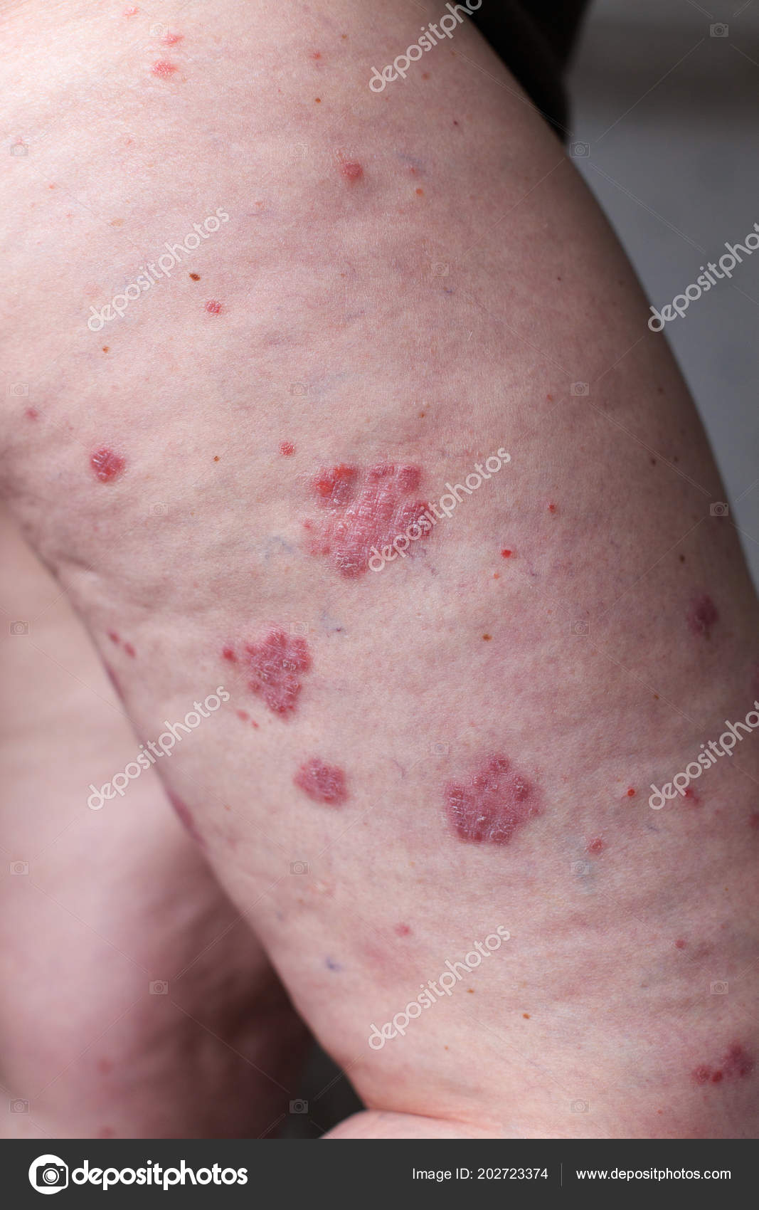 Psoriasis Vulgaris Is An Autoimmune Disease That Affects The Skin