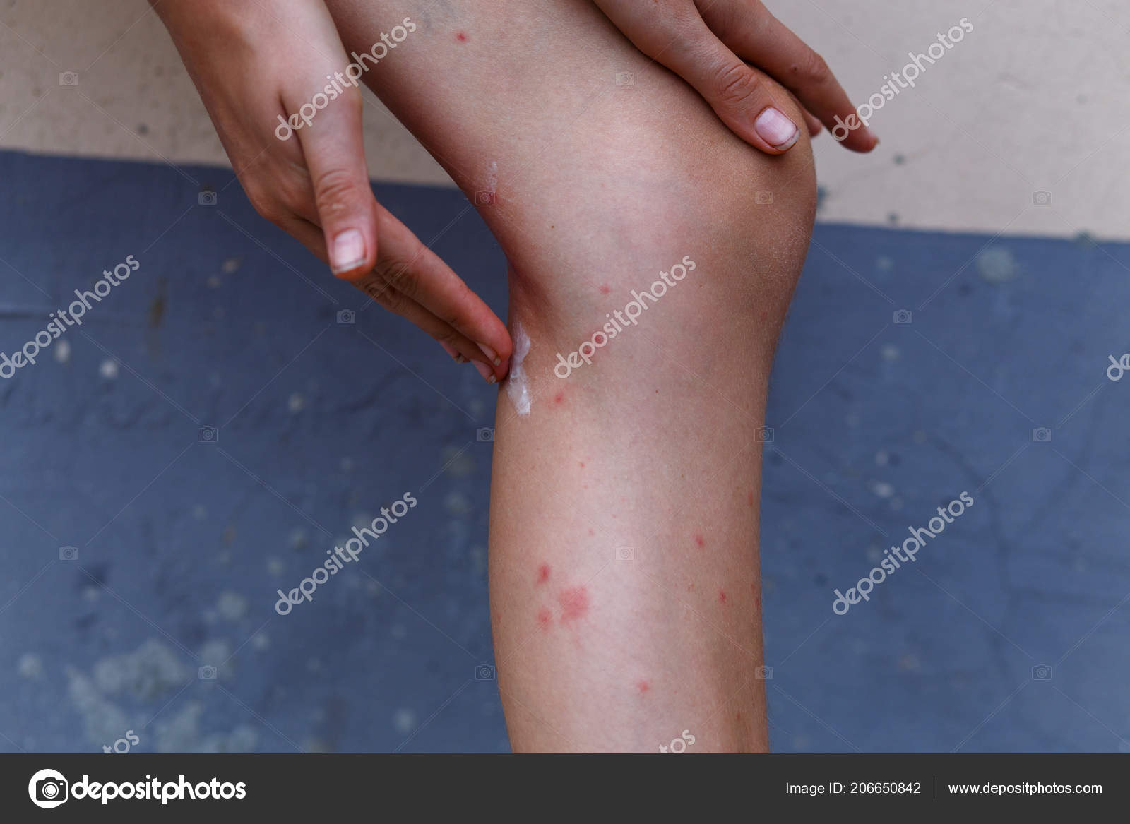 Scratch Soft Itchy Red Bumps Skin Mosquito Bites Left Leg — Stock Photo ...