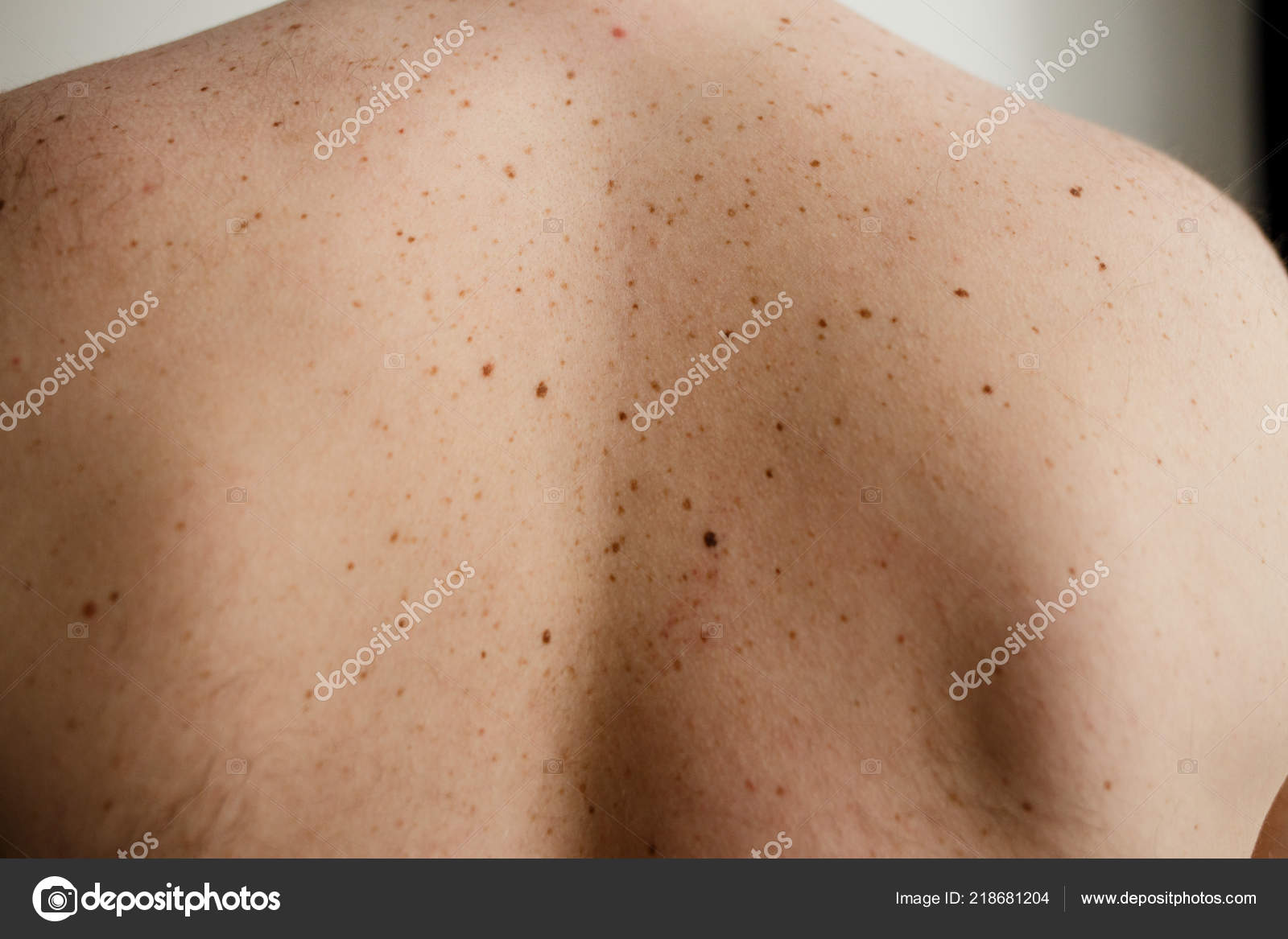 Close up detail of the bare skin on a man back with scattered moles and ...