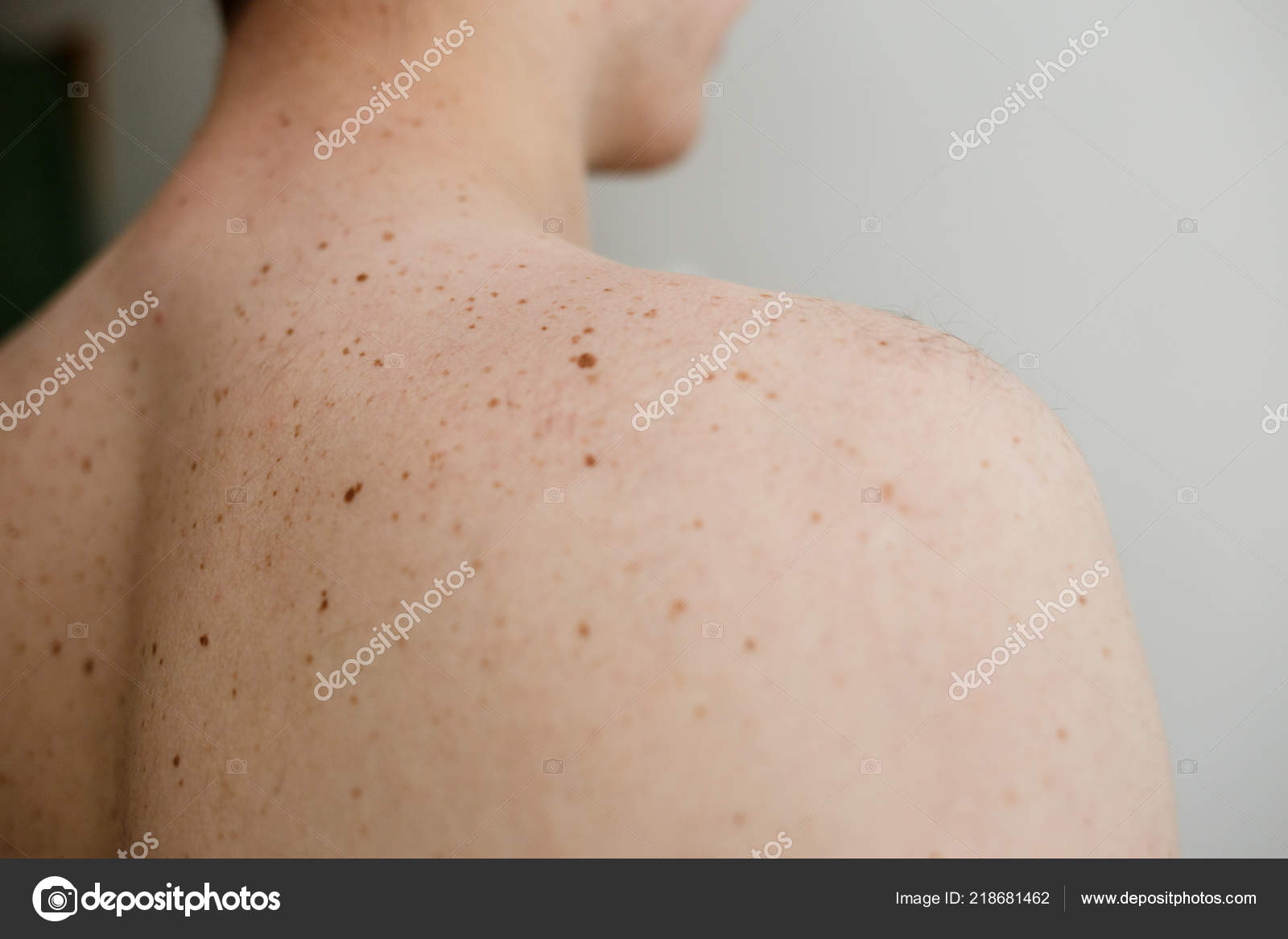 Freckles All Over Body