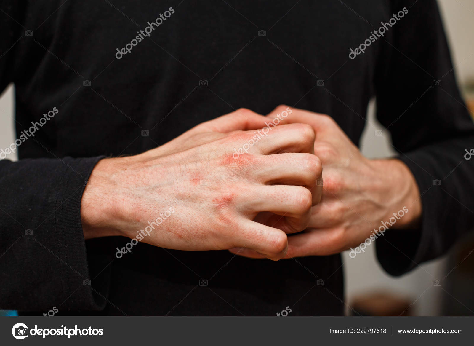 El hombre se rasca a sí mismo, la piel seca escamosa en la mano con ...