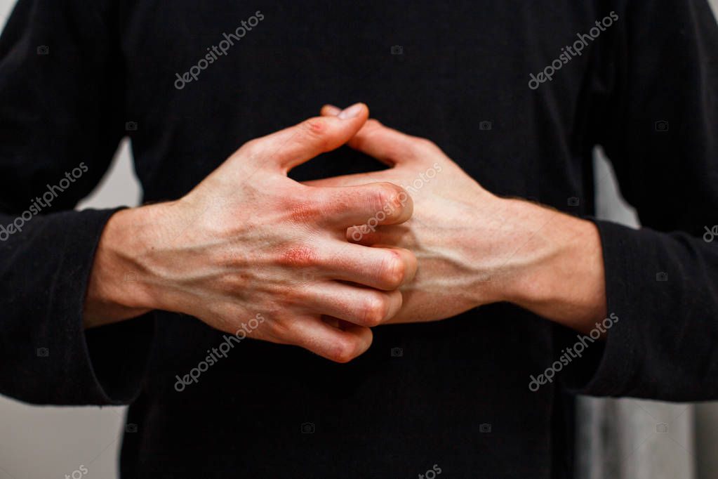 El hombre se rasca a sí mismo, la piel seca escamosa en la mano con ...