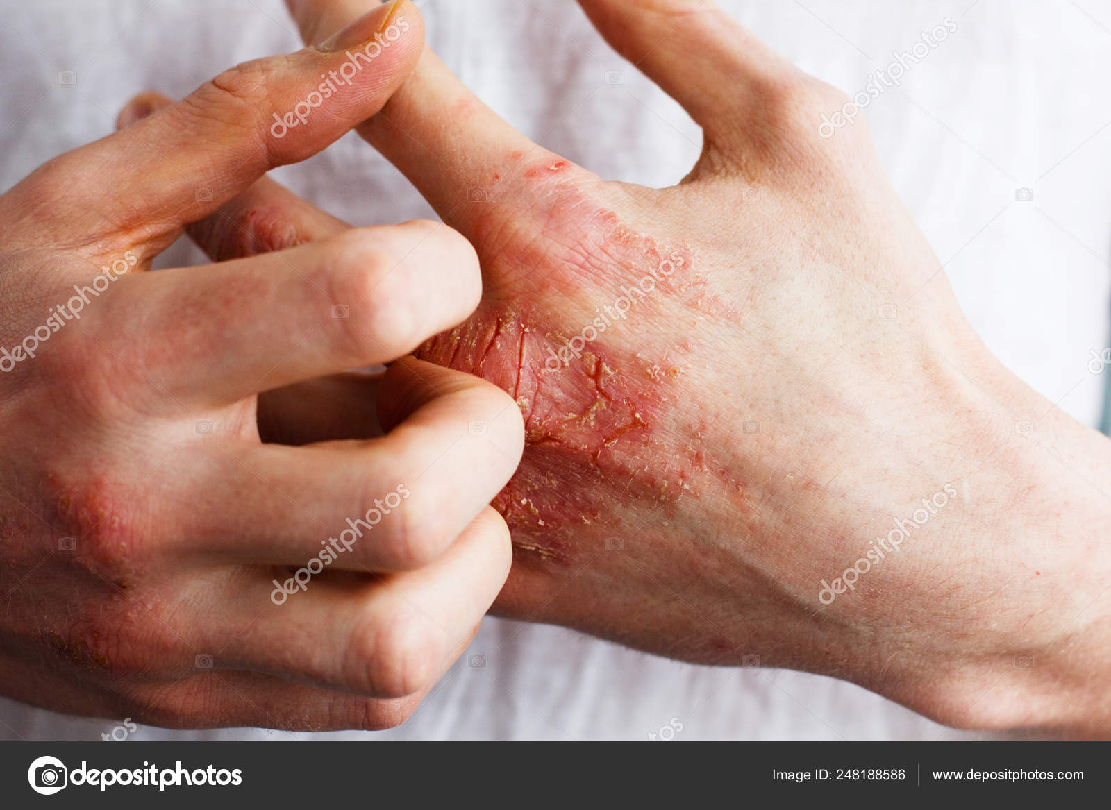 Dry Hands Rash