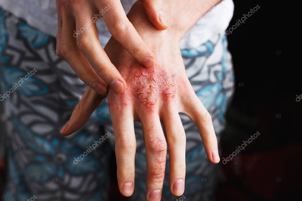 El hombre se rasca a sí mismo, la piel seca escamosa en la mano con ...