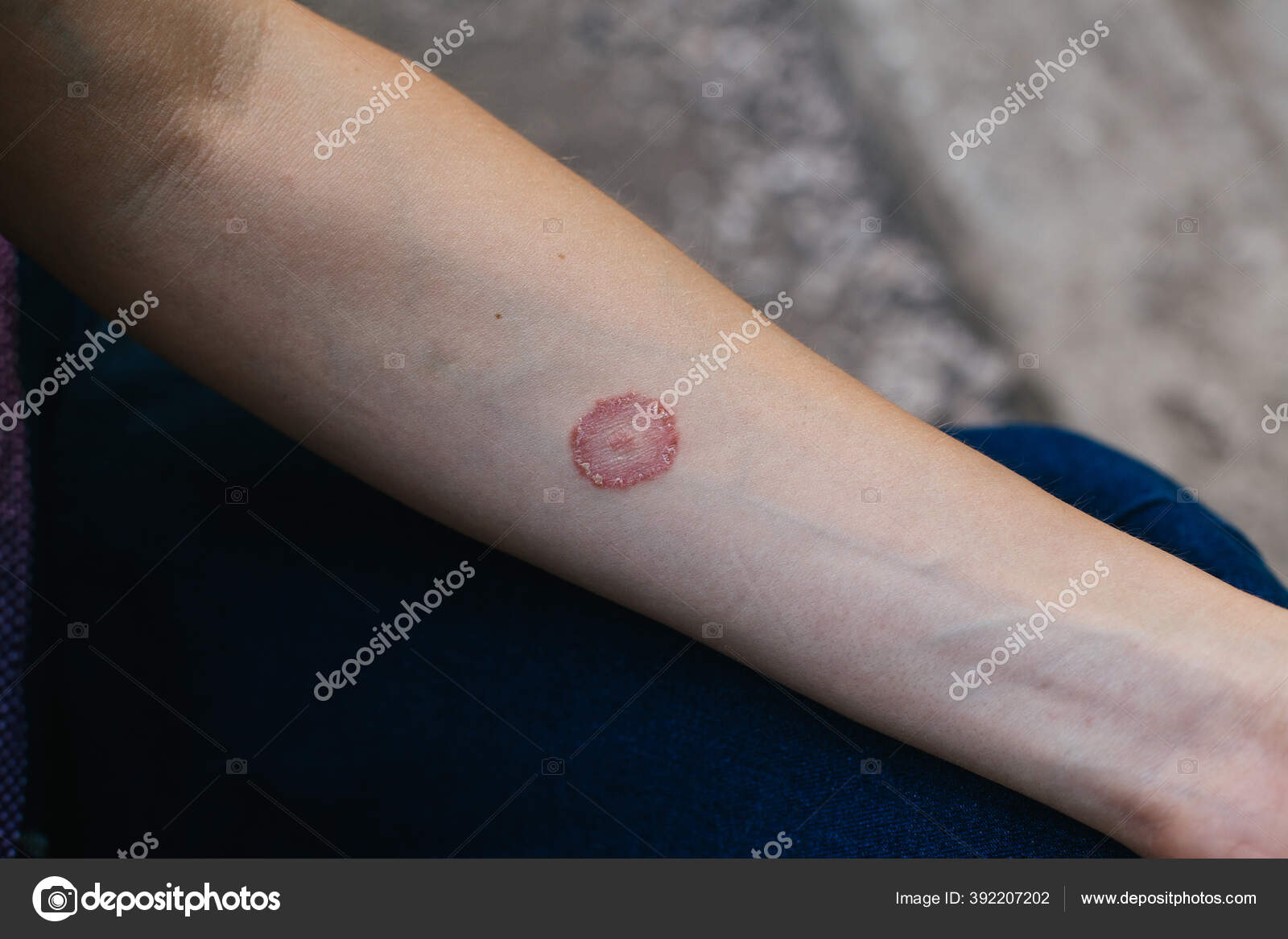 Infection par le ver annulaire, dermatophytose cutanée. Appliquer un ...