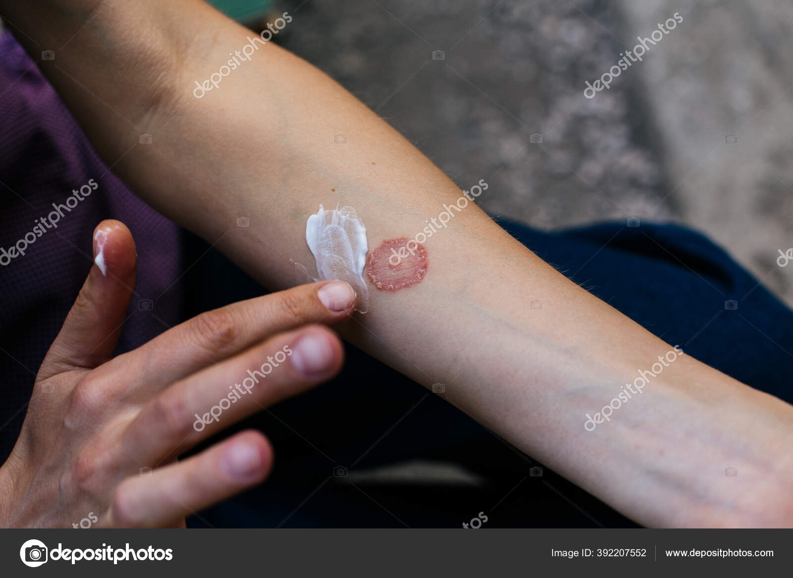 Ring Worm infection, Dermatophytosis on skin. Applying an emollient to ...