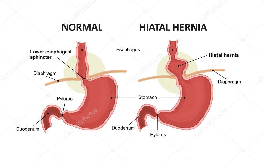 Hernia hiatal y anatomía normal del estómago 2022