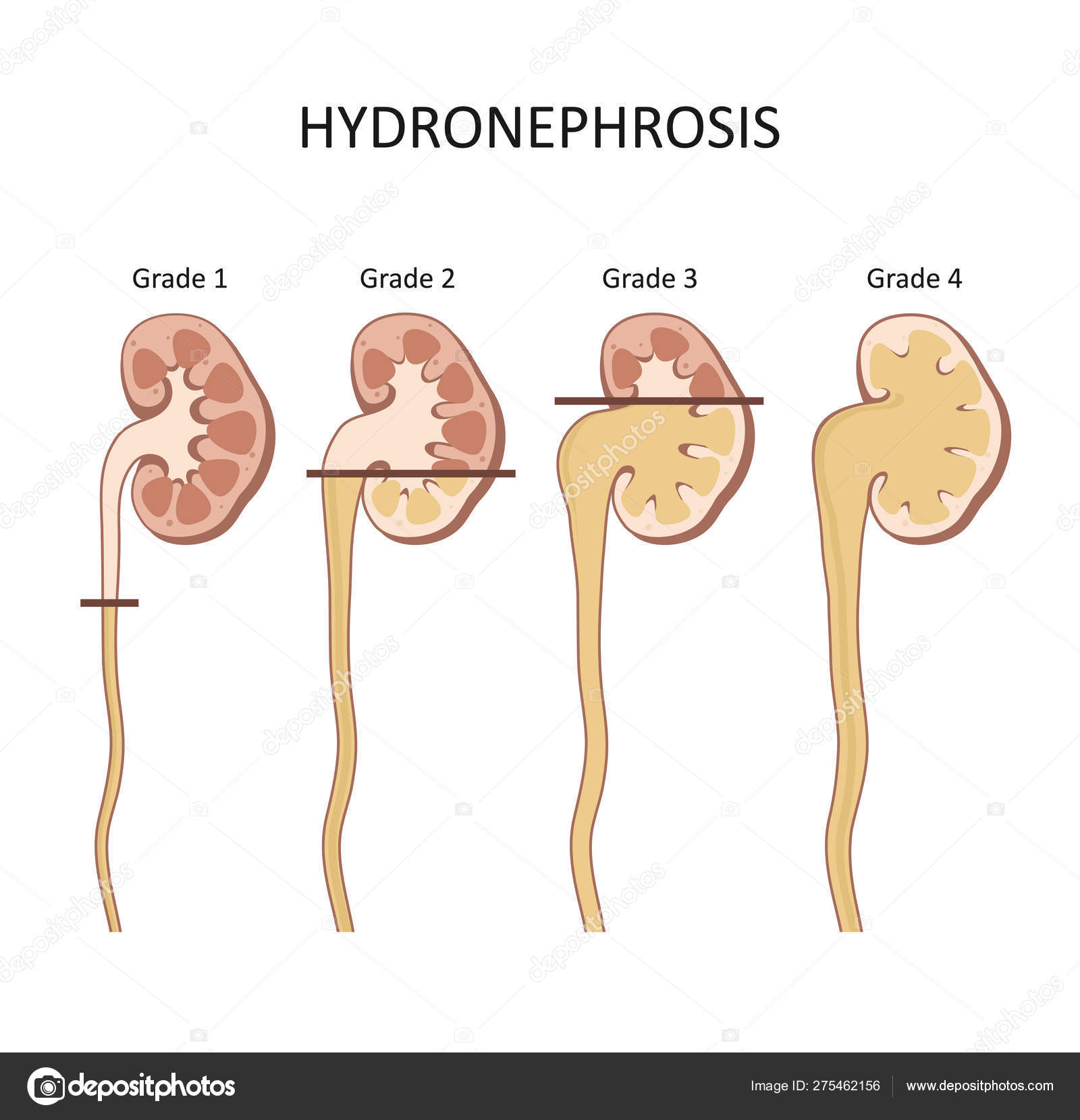 Hydronephrosis stage. Vector illustration Stock Vector by ©nnfotograf ...