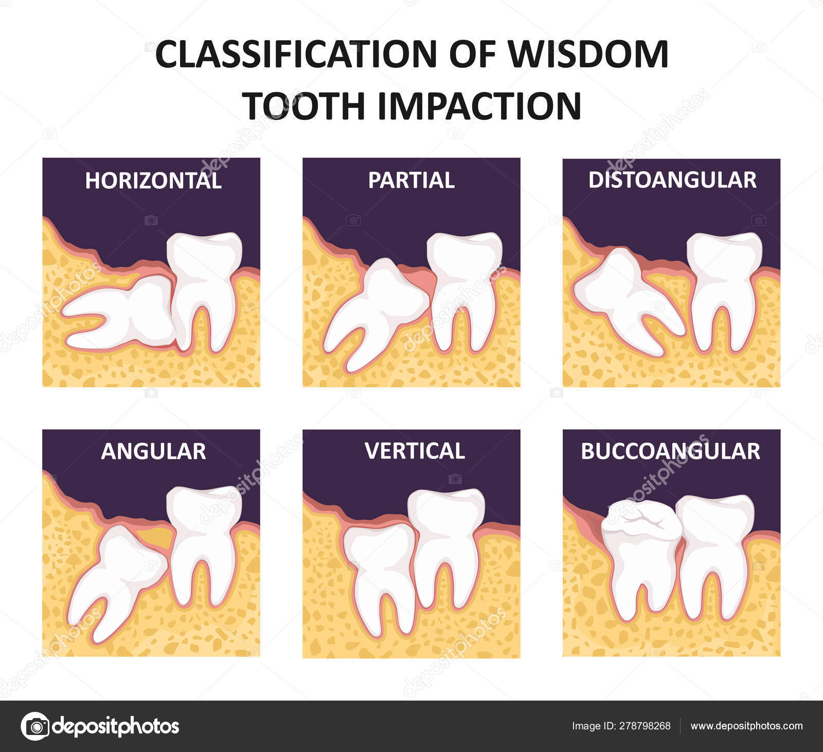 Classification de l'impaction des dents de sagesse image vectorielle ...