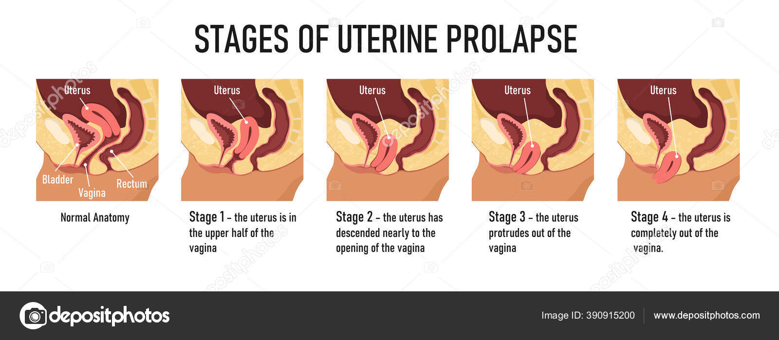 Etapas Del Prolapso Uterino Ilustración Vectorial Vector Gráfico