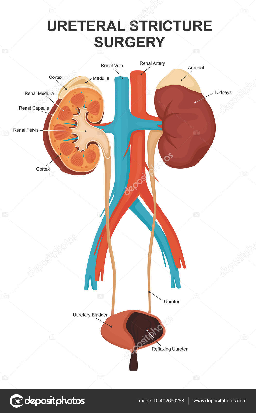 Ureteral stricture surgery. The structure of the kidneys, the adrenal ...