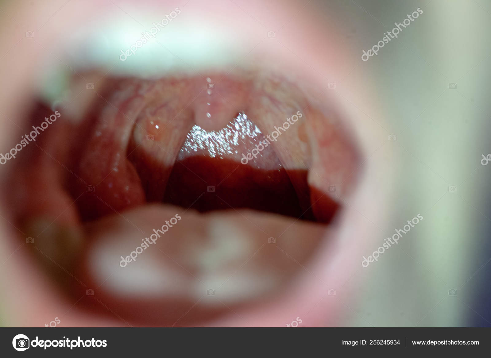 Inside Throat