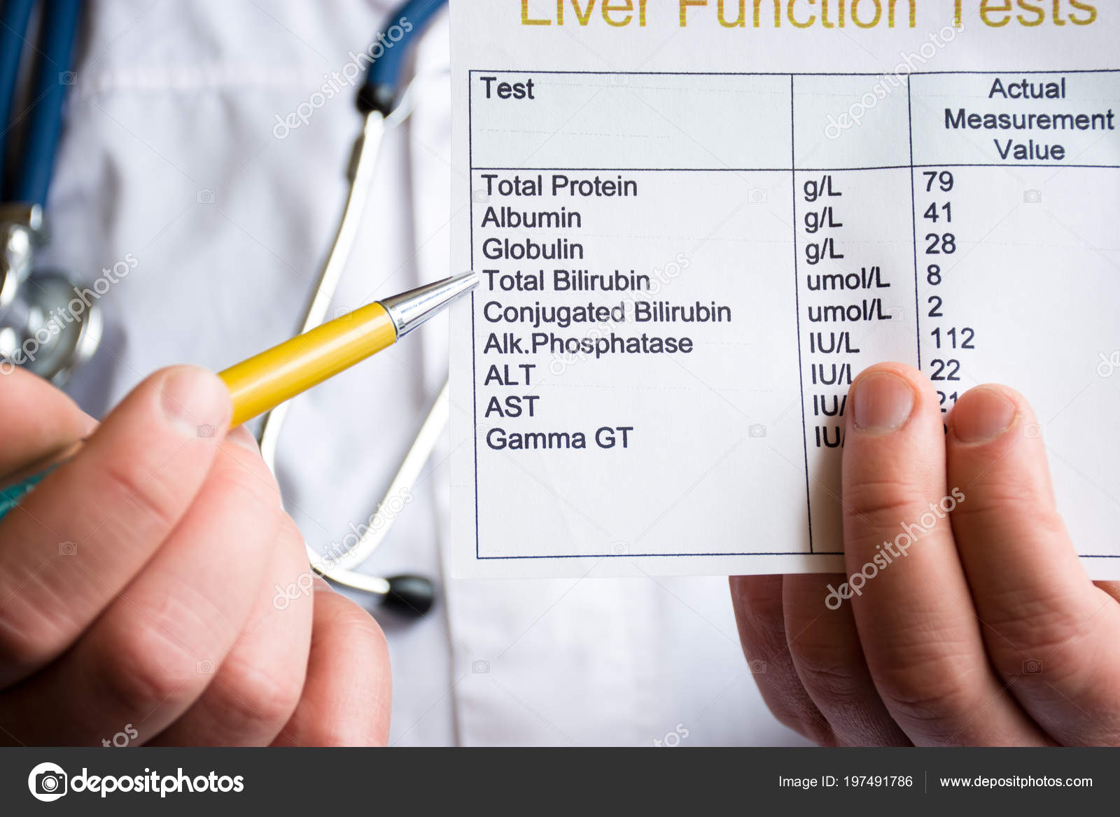 Analysis Bilirubin Concept Photo Doctor Holding Laboratory Test Liver ...