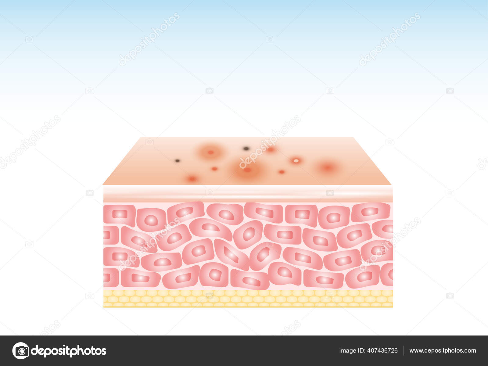 Acne Skin Spot Pimple Problem Vector Design Stock Vector Image by ...