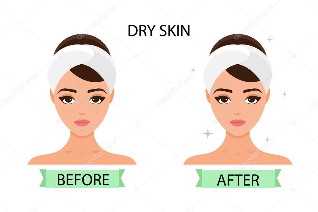 La chica tiene la piel seca en la cara. Antes y después. Concepto de ...