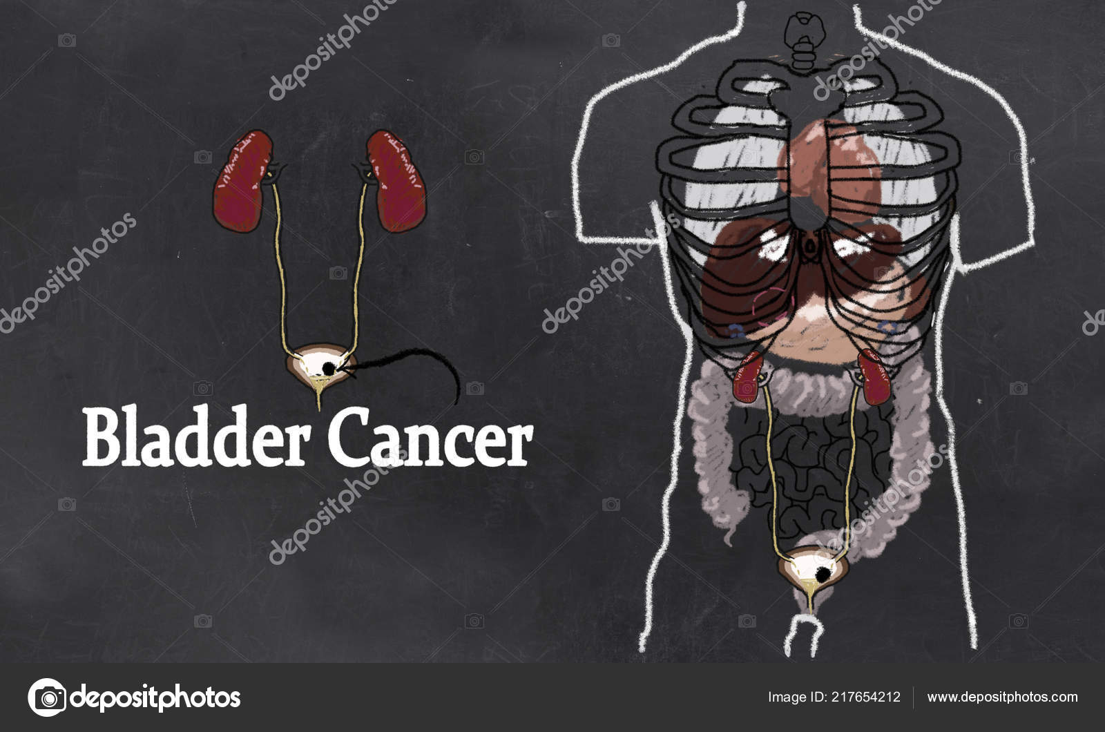 Bladder Cancer Anatomy Illustration Urinary Tract System Simple Drawing ...