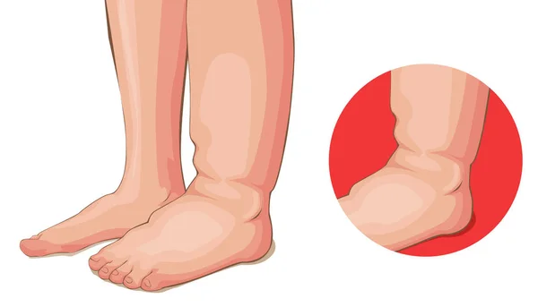 Swelling Vector Art Stock Images | Depositphotos