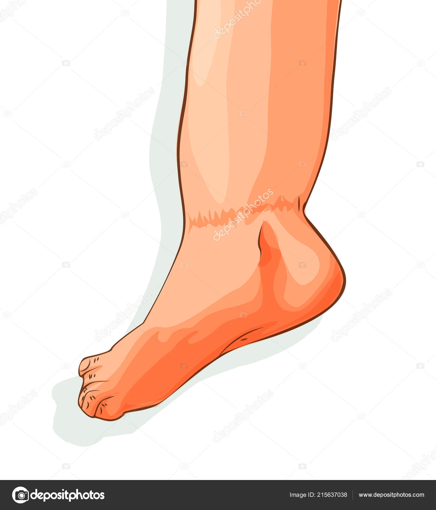 Ilustración Vectorial Edema Los Pies Hinchazón Los Pies Tobillos vector ...