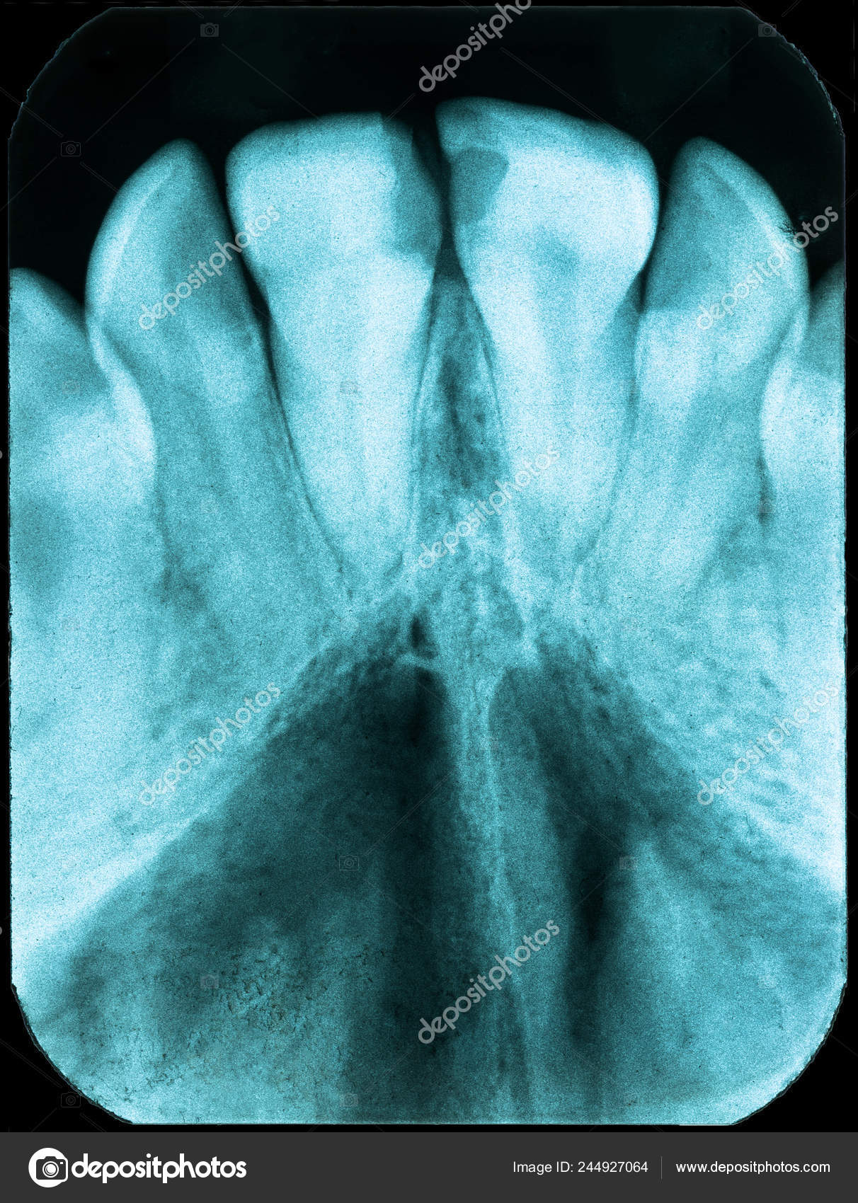 X Ray Of Bad Teeth