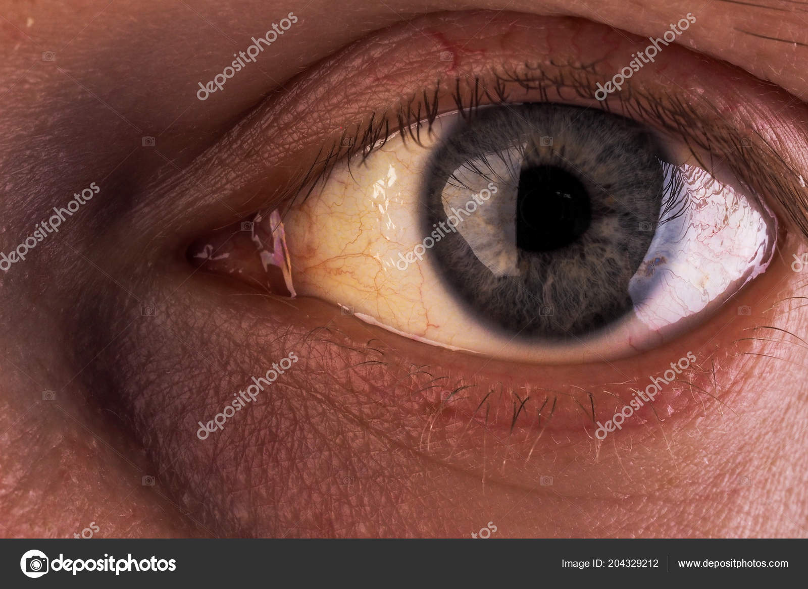 Gule øyne Gulsott Voksne Bukspyttkjertelkreft, Symptomer