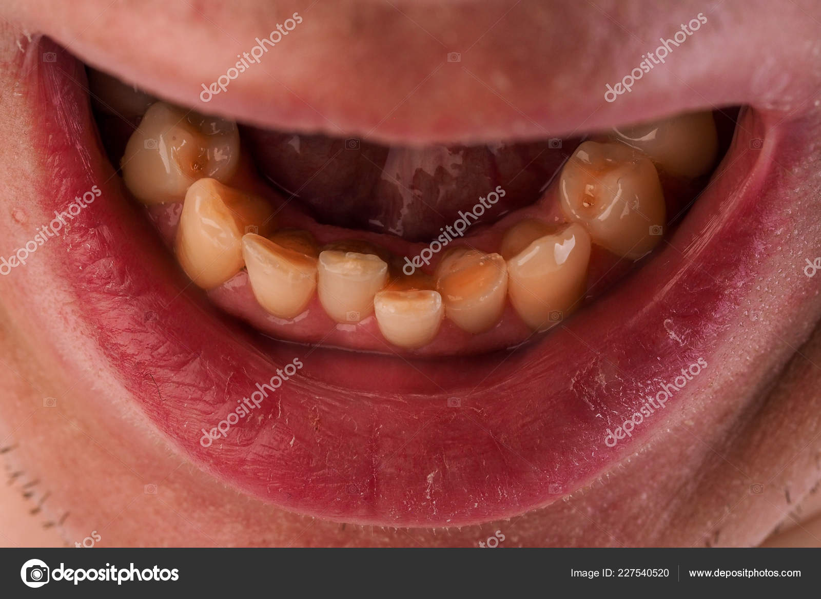 Crooked Bottom Front Teeth