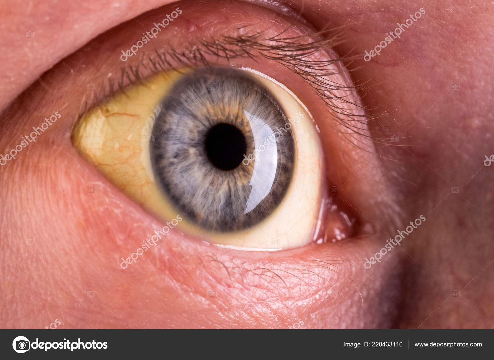 Gule øyne Gulsott Voksne Bukspyttkjertelkreft, Symptomer