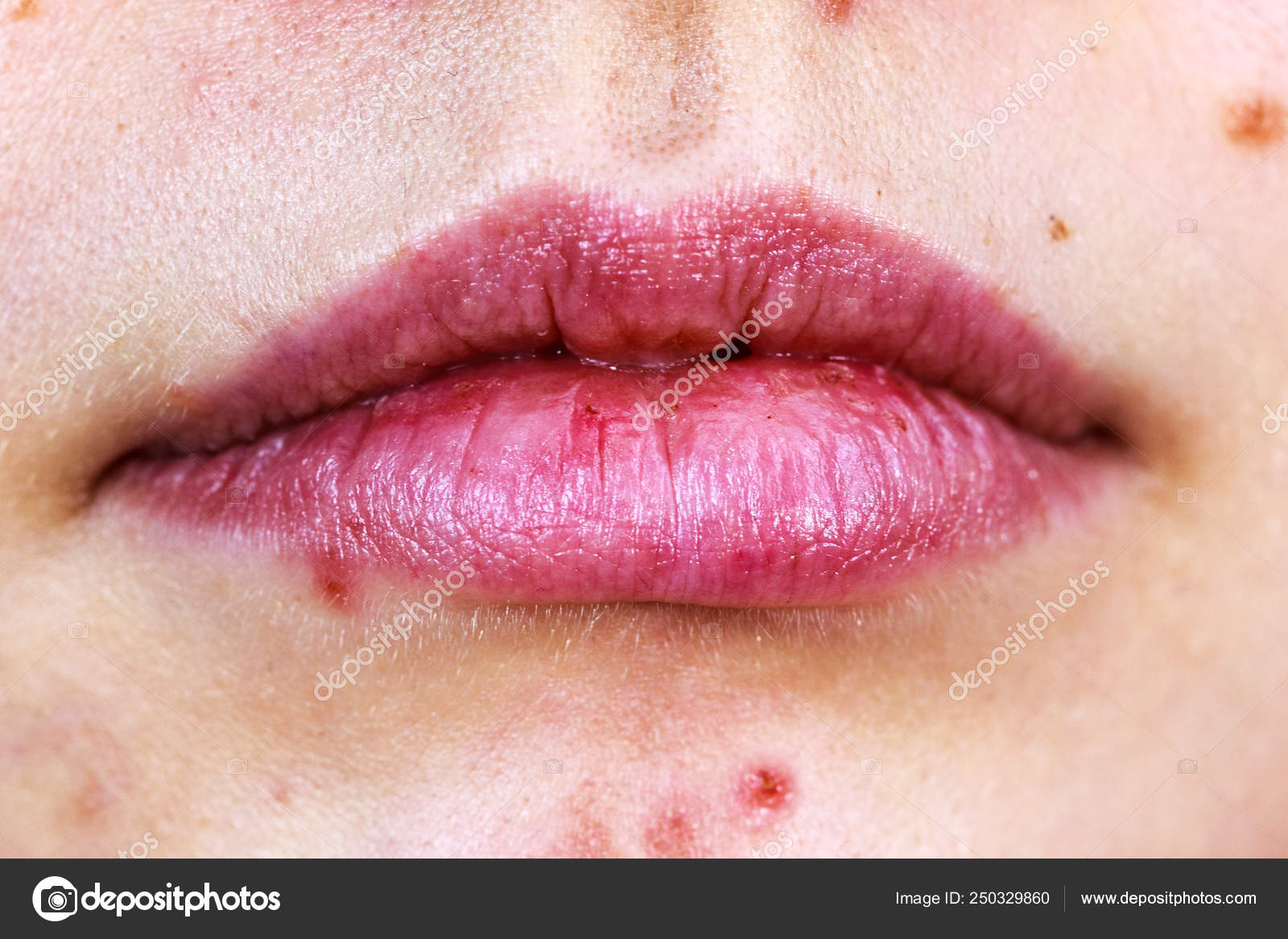 Cara femenina con acné problema de la piel — Foto de stock © Anetlanda ...