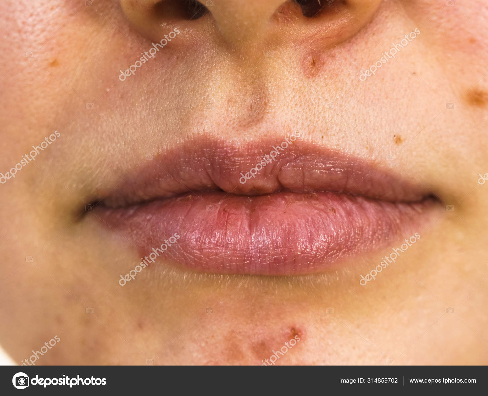 Cara femenina con acné problema de la piel — Foto de stock © Anetlanda ...