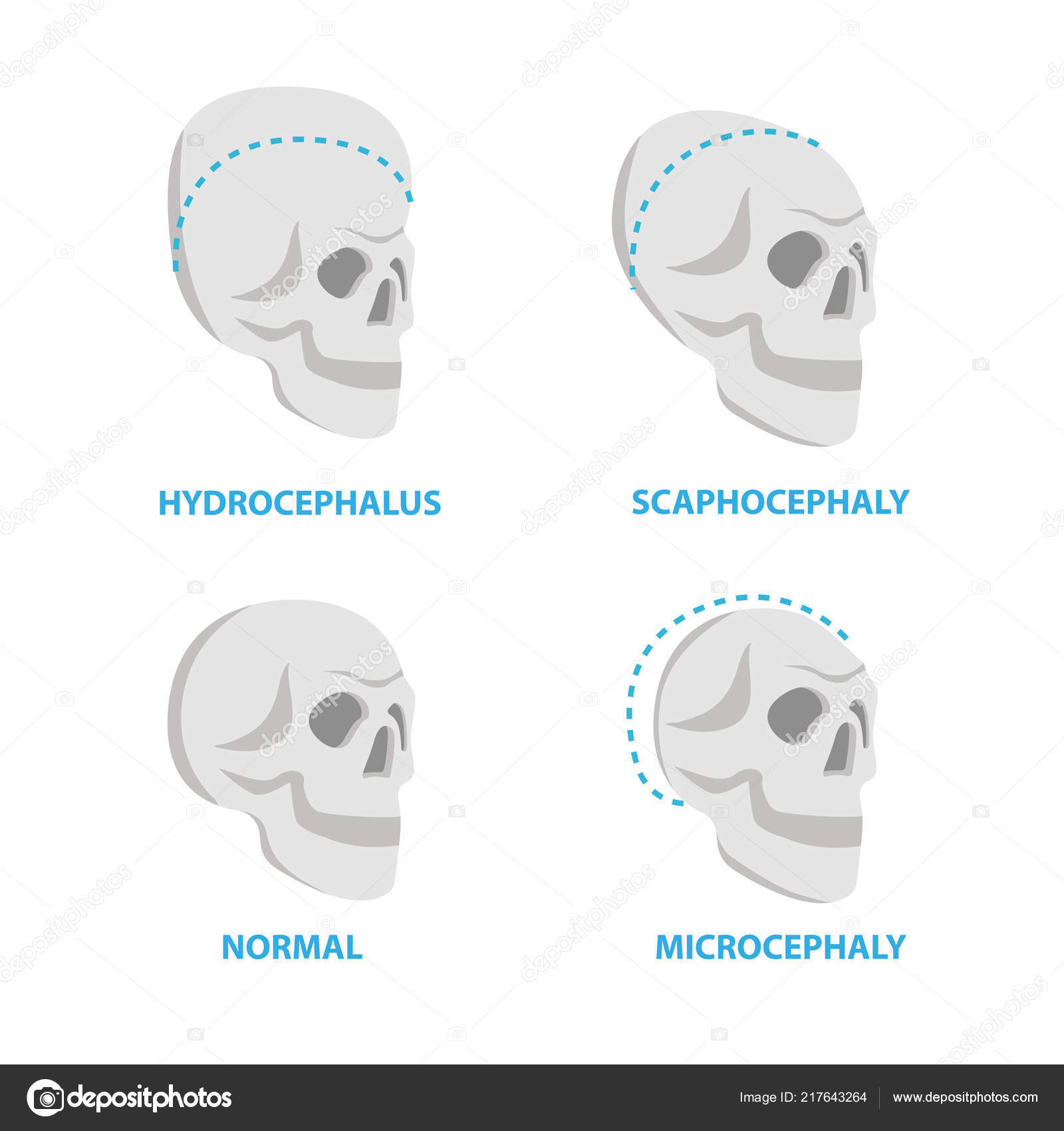 Microcephalic Skull