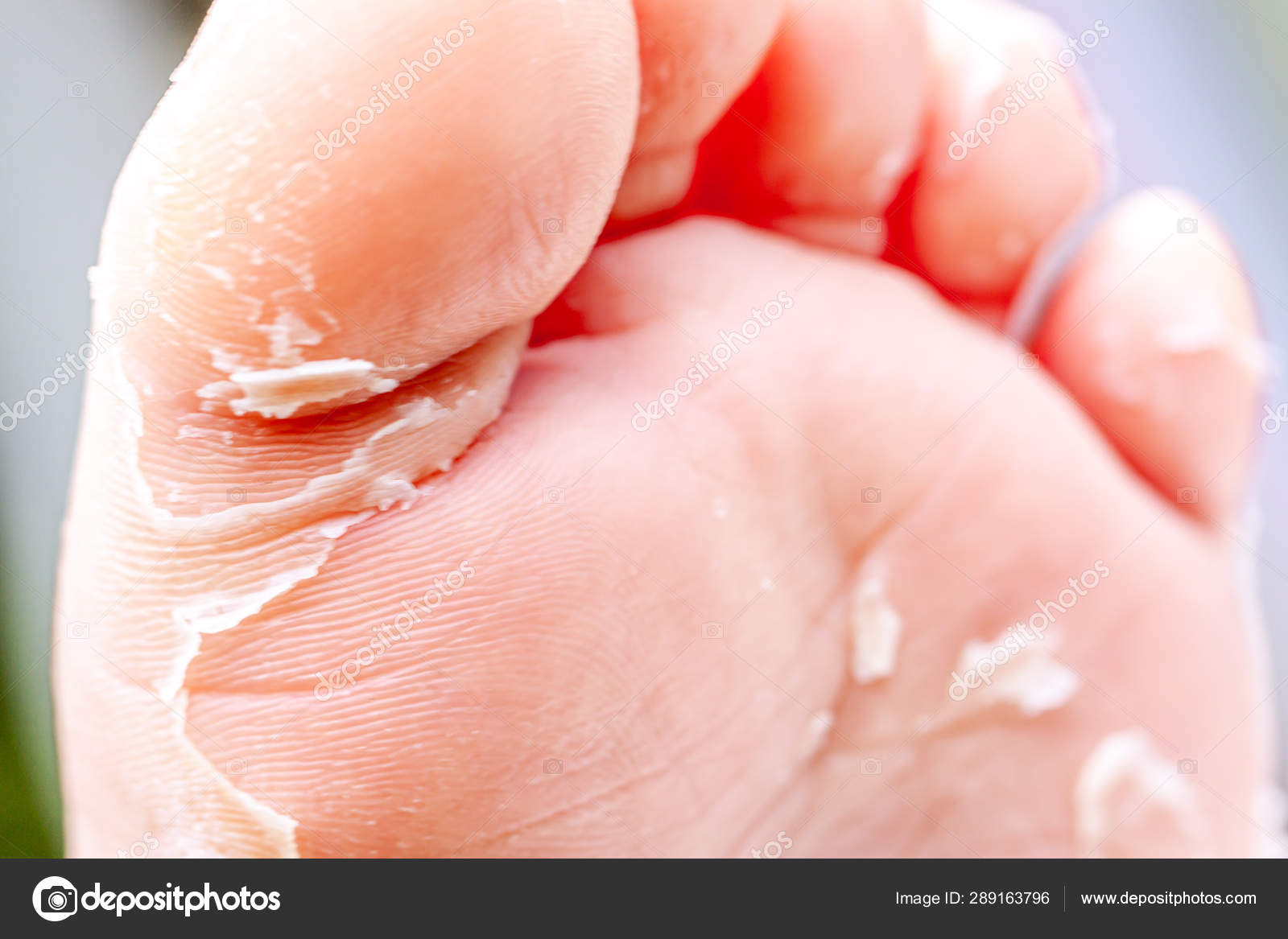 Scarlet Fever Rash Peeling