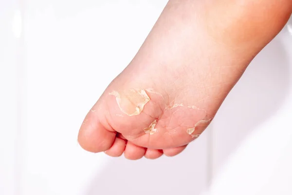 Nach dem roten Hautausschlag und der durch Scharlach verursachten ...