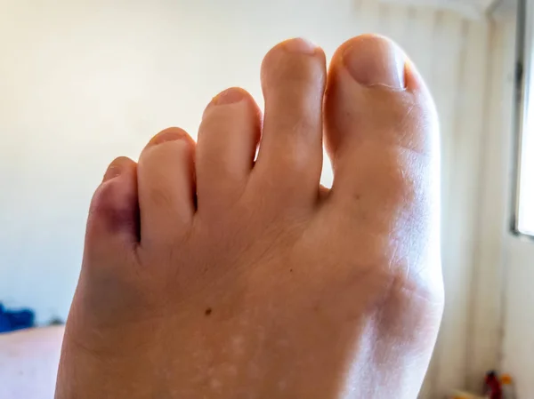 Toe amputation Stock Photos, Royalty Free Toe amputation Images ...