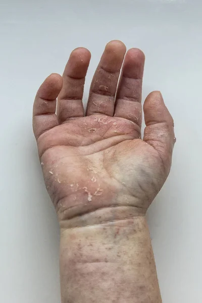 Scarlatina Two Children Hands Contagious Red Small Rash White ...