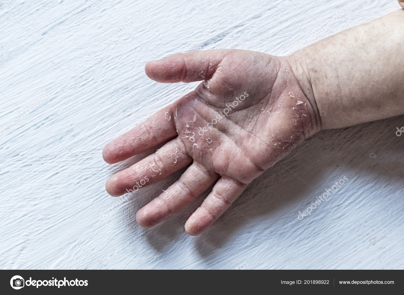 Scarlatine Deux Mains D'enfants Avec Petite Éruption Cutanée Rouge ...