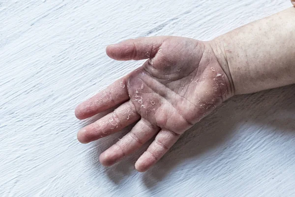 Scarlatina Two Children Hands Contagious Red Small Rash White ...