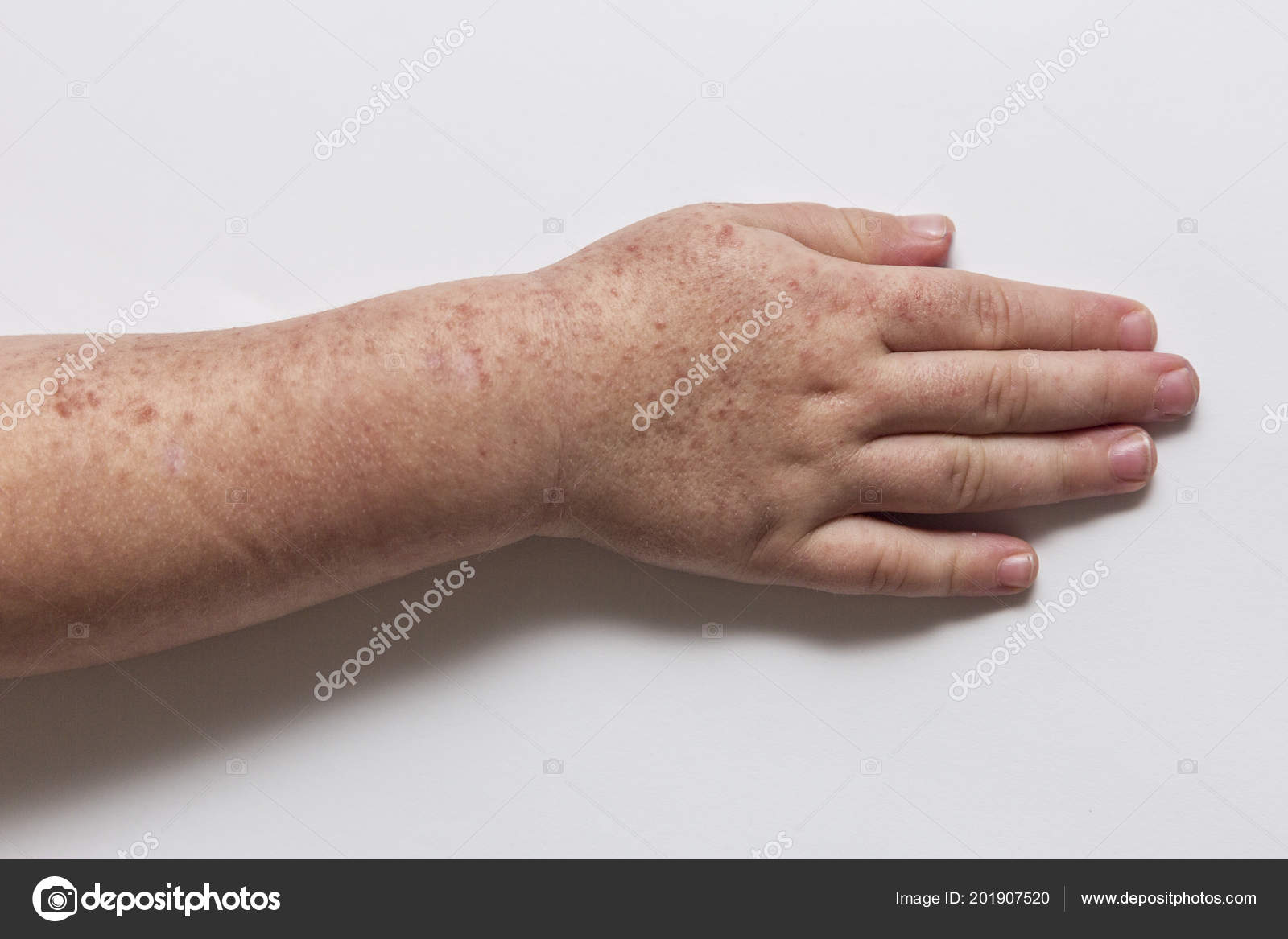 Scarlatina Two Children Hands Contagious Red Small Rash White ...