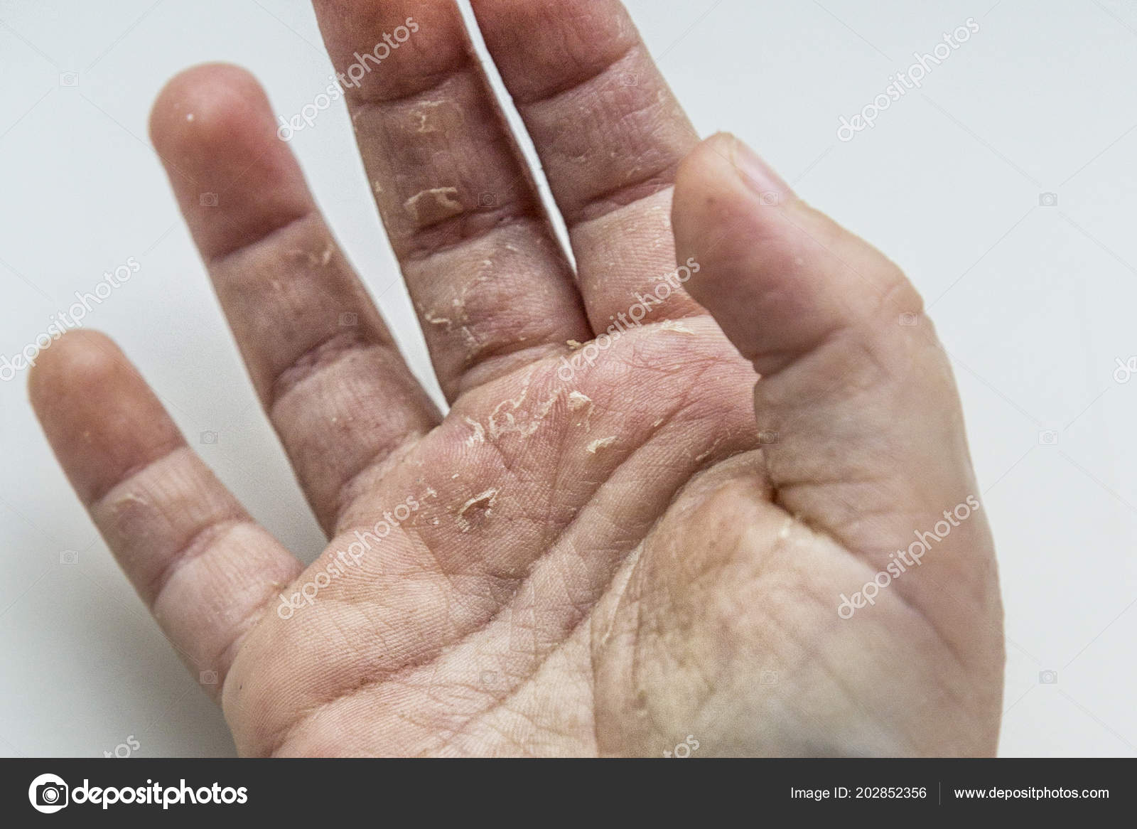 Scarlatina Dos Niños Manos Con Contagioso Sarpullido Rojo Pequeño Fondo ...