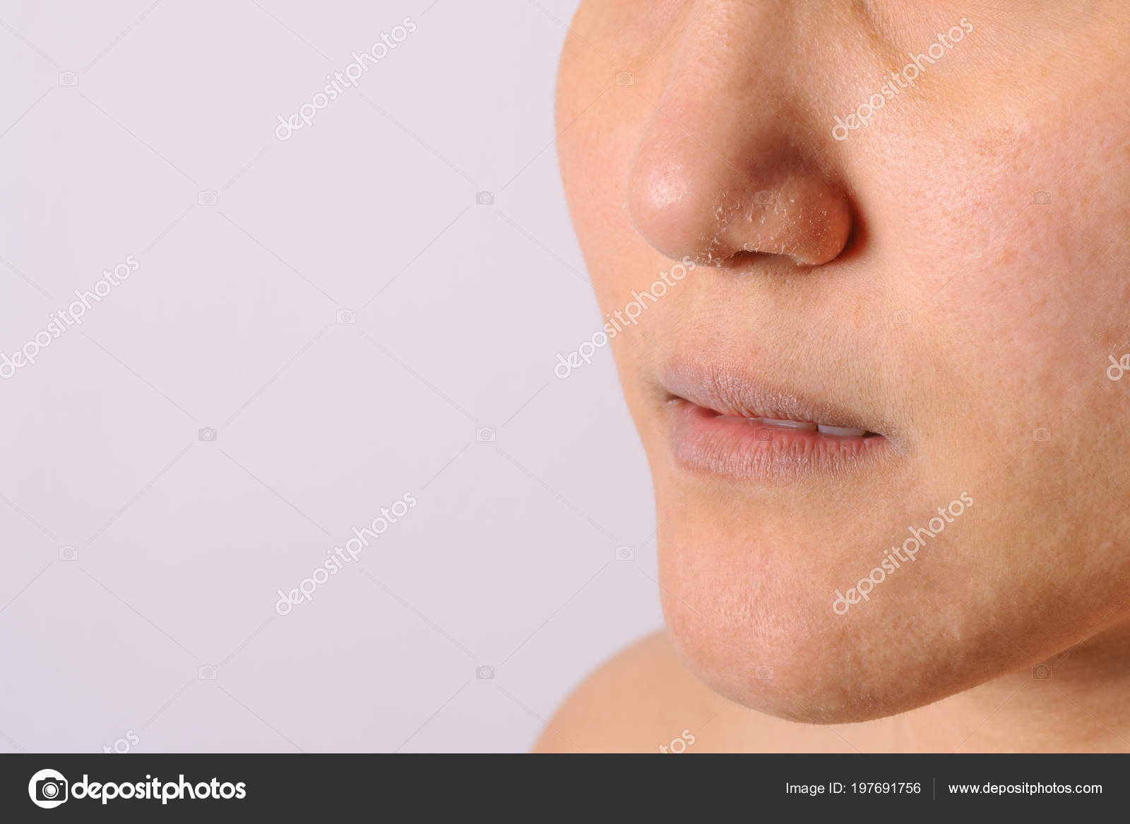 Eczema Around Nose And Lips at Lloyd Sutton blog