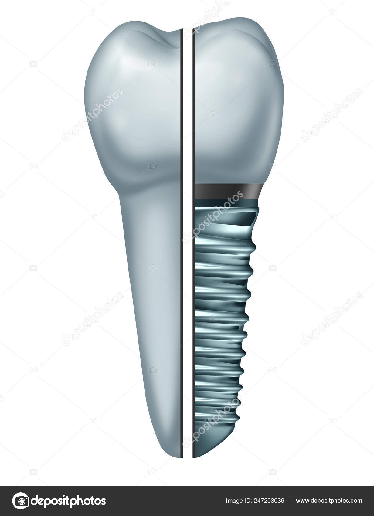 Dental Implant Tooth Endosseous Tooth Prosthetic Comparison Orthodontic ...