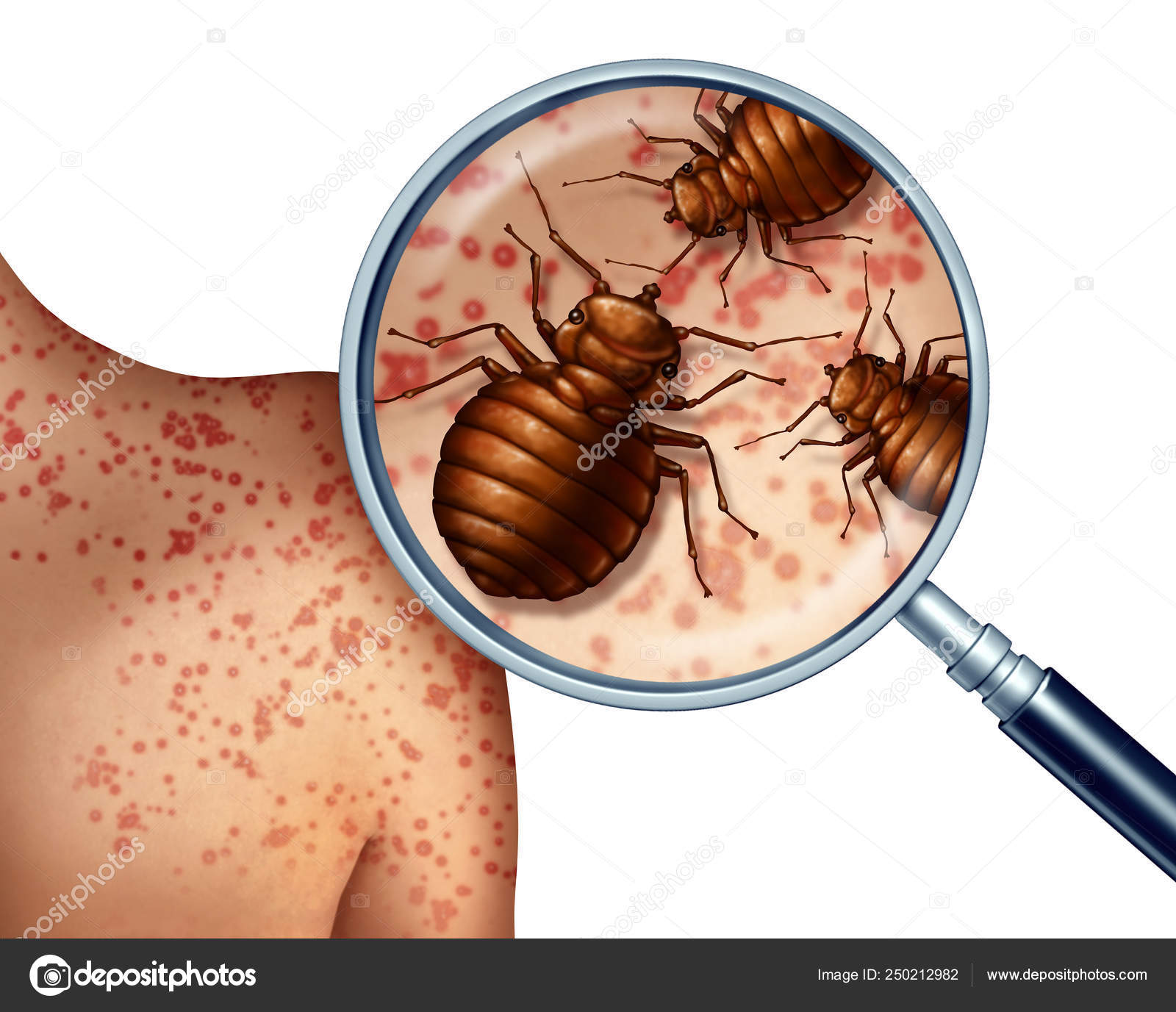 Bed Bug Bites — Stock Photo © lightsource #250212982
