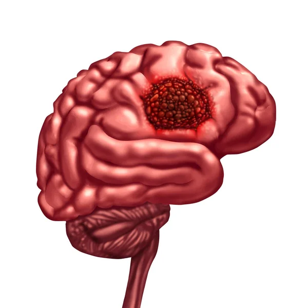 Cerebral tumors Stock Photos, Royalty Free Cerebral tumors Images ...