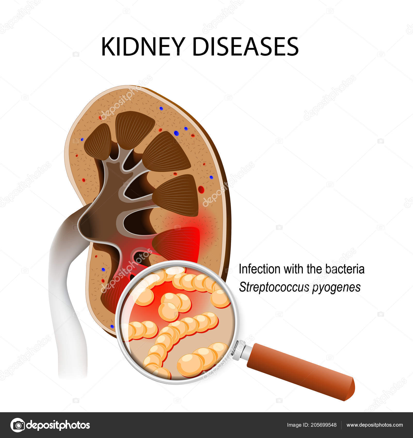 Image vectorielle Maladie Rénale Rein Humain Avec Infection Bactérienne ...